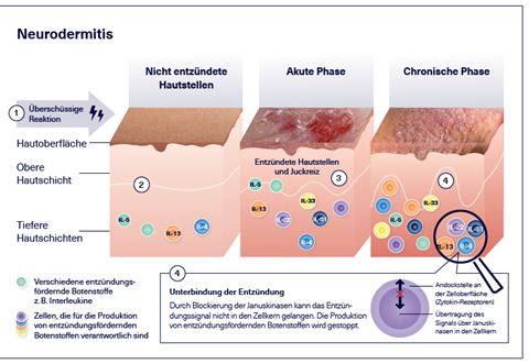 Neurodermitis verstehen